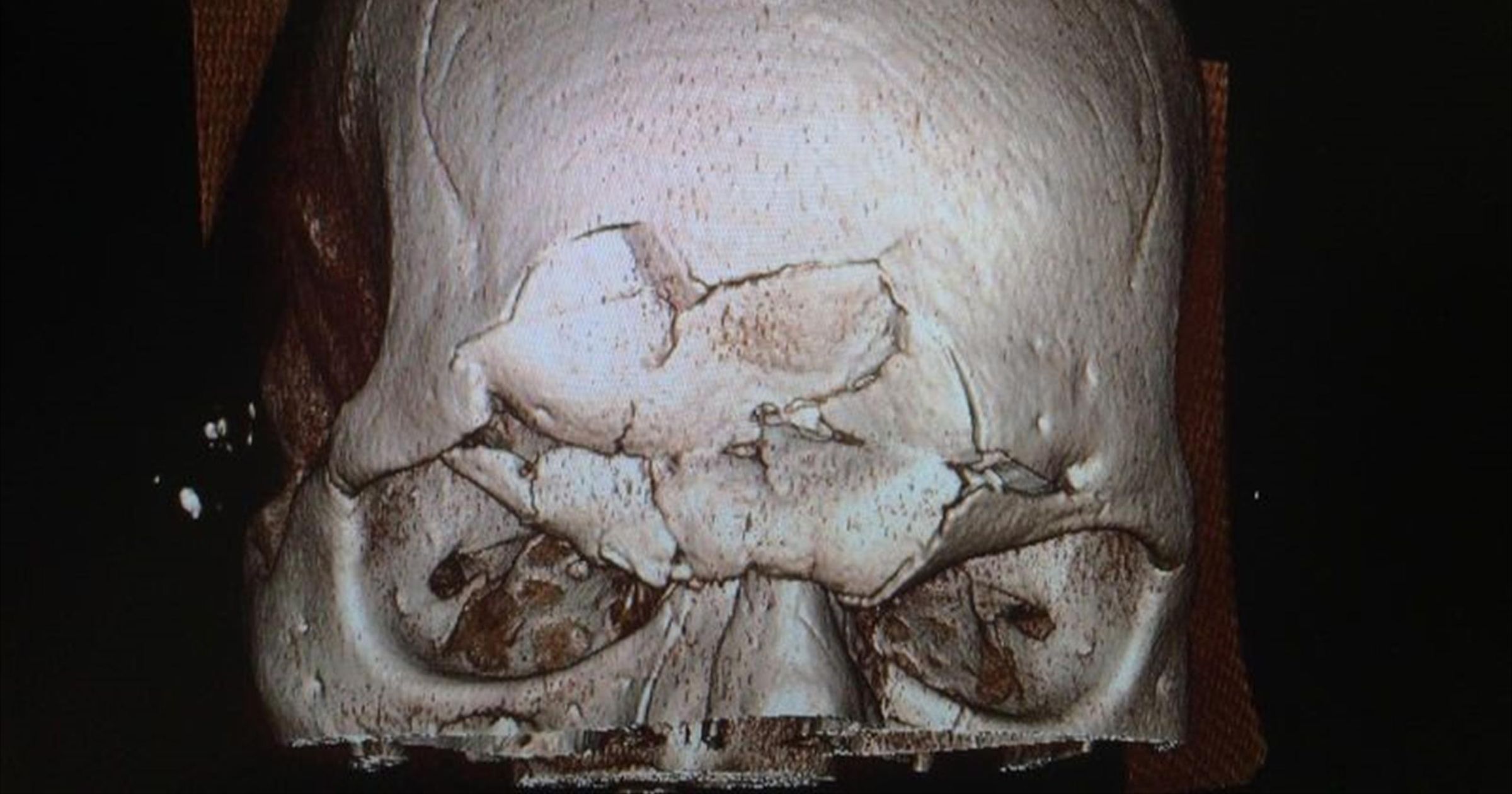 Evangelista 'Cyborg' Santos vows to return despite fractured skull ...